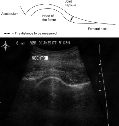 Sonography for hip joint effusion in adults with hip pain | Annals of ...