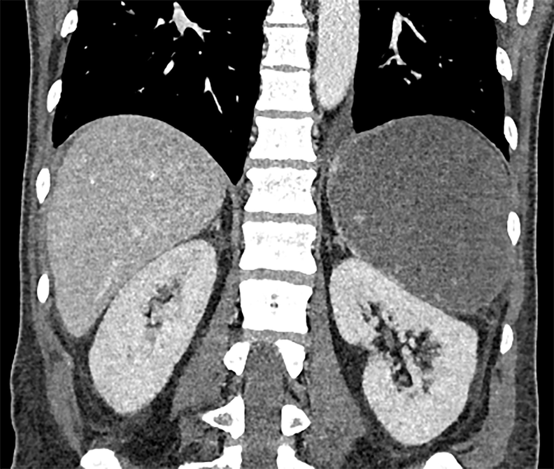 Enlarged Spleen What Is The Spleen? CLL Society
